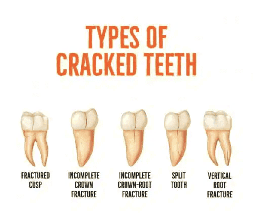 Expert Treatment for Tooth Fractures in North Kolkata | Dr. Ranu Choudhury